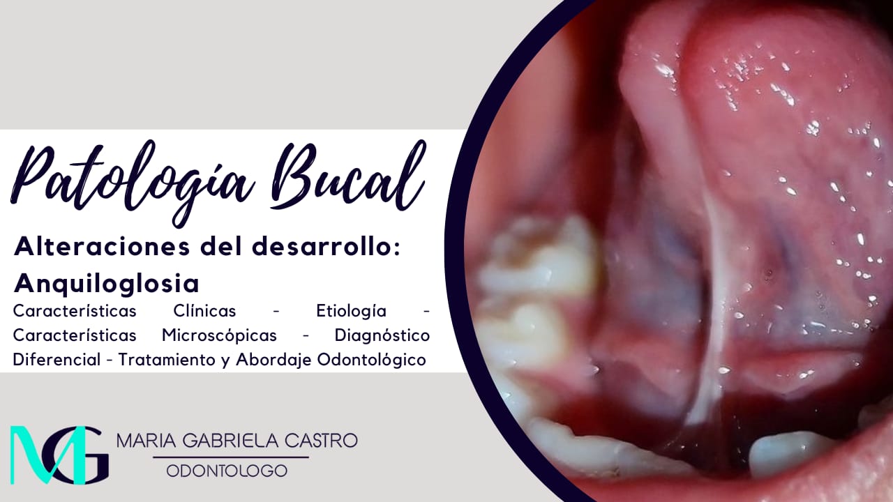 La anquiloglosia: Características Clínicas, Etiología, Características ...