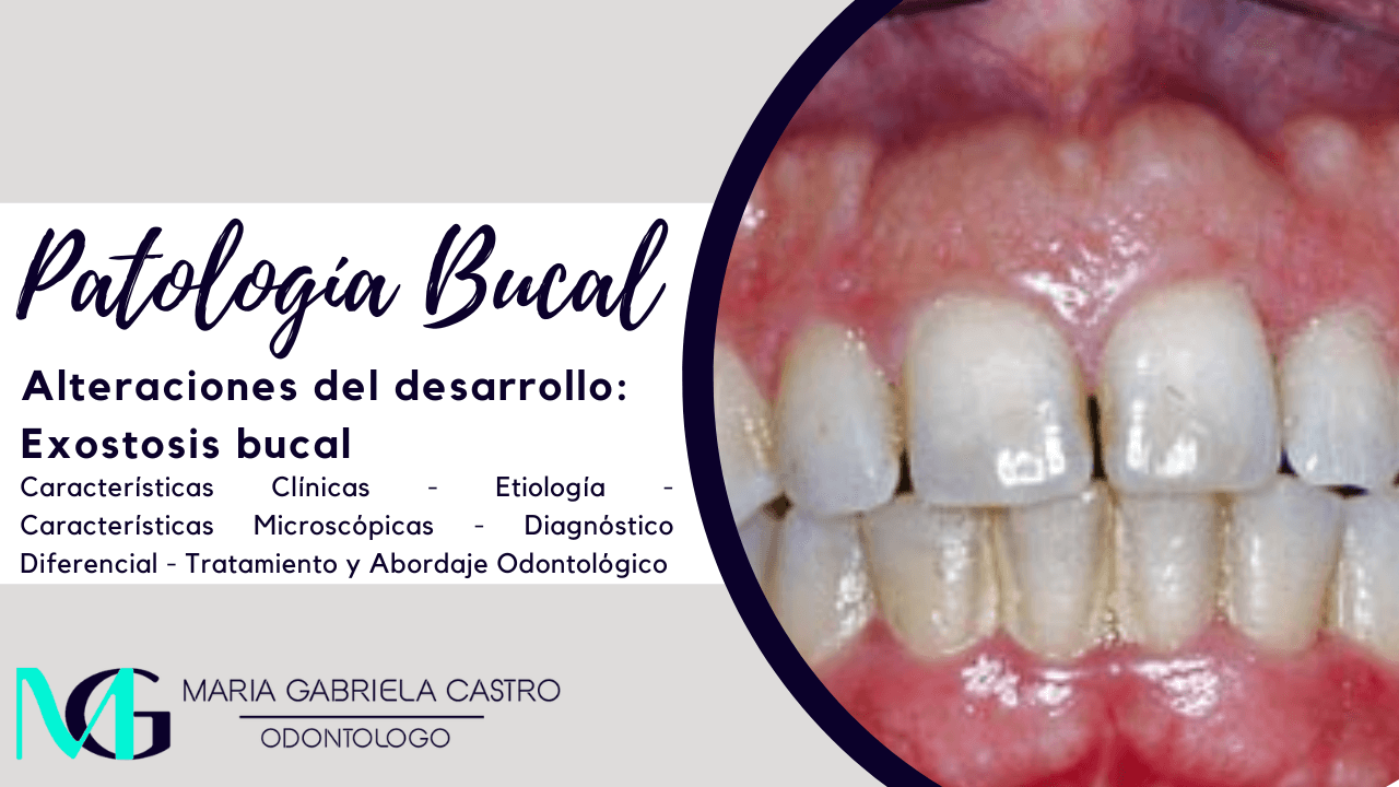 Las exóstosis bucales: Características Clínicas, Etiología ...