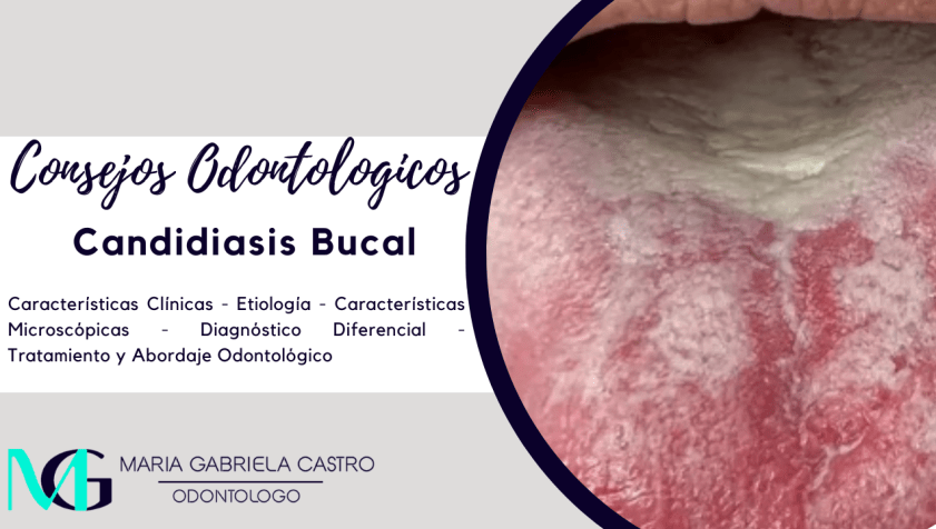 Candidiasis Bucal: Características Clínicas, Etiología, Características ...